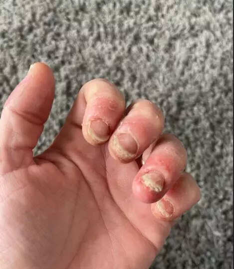 A Deadly Allergy To Nail Polish Causes Woman To Lose Movement in ...