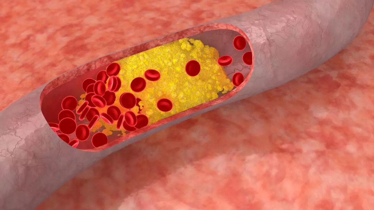 High Cholesterol Symptoms: Signs Of The Deadly Condition That Appears ...
