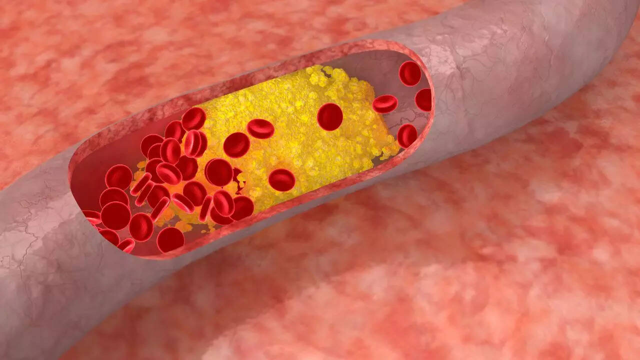 High Cholesterol Symptoms: Painful Sign In Your Arm Which Can Help You ...