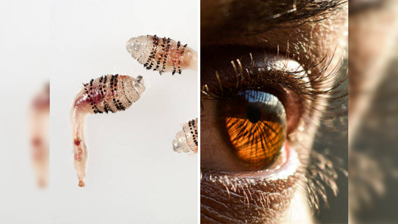 Man's 'itchy eye' turns out to be a dozen squirming fly larvae around ...
