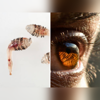 Man's 'itchy eye' turns out to be a dozen squirming fly larvae around ...