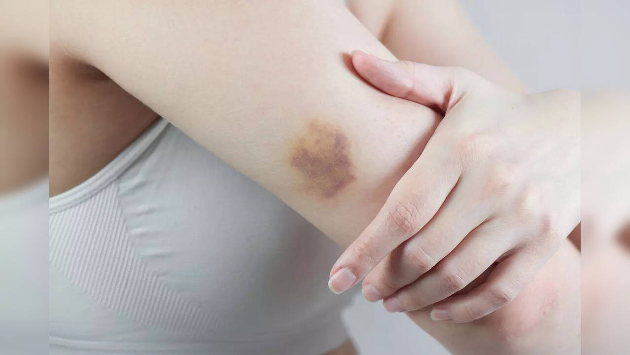 Fatty liver disease: Easy bruising and other symptoms you need to know ...