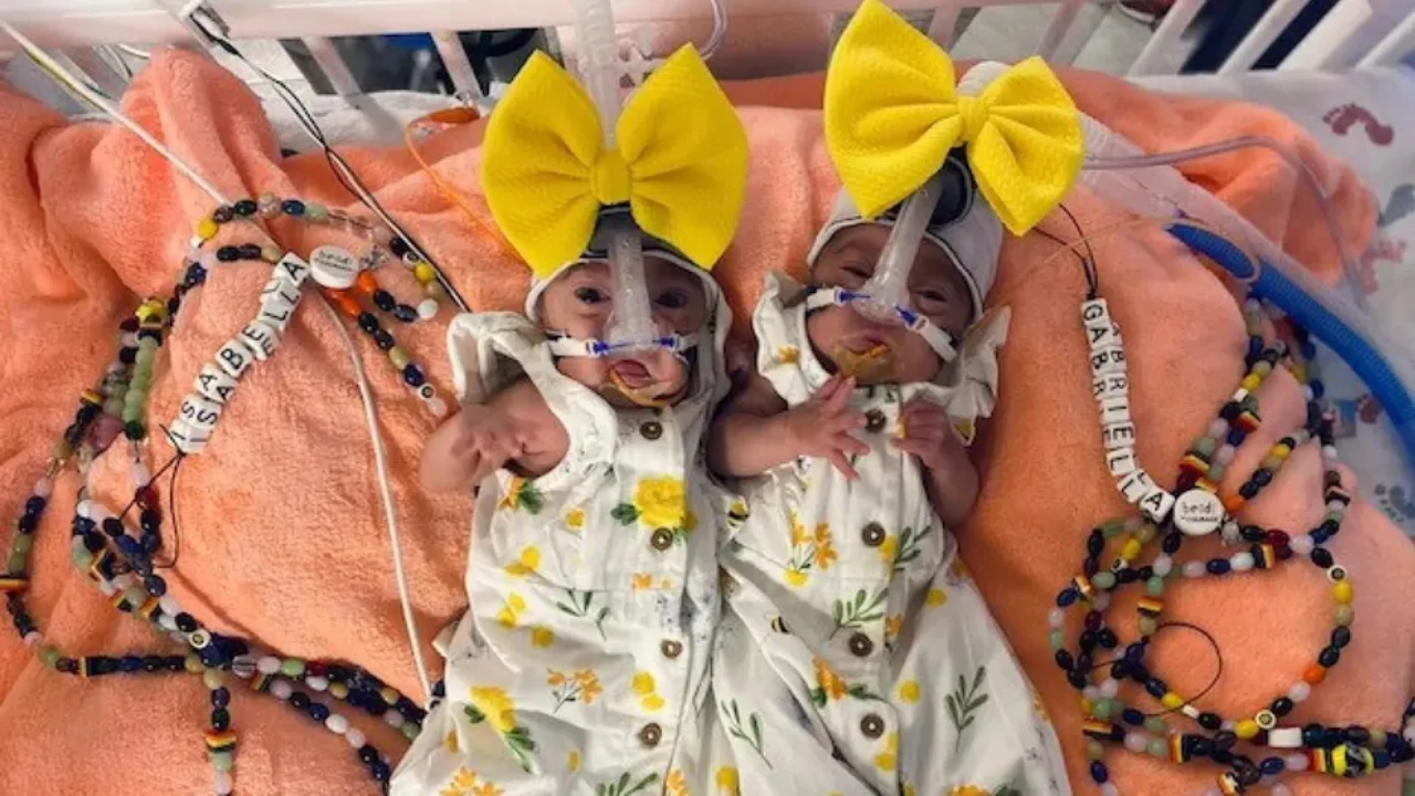 Woman gives birth to identical twins 3 days apart, doctor says it's ...