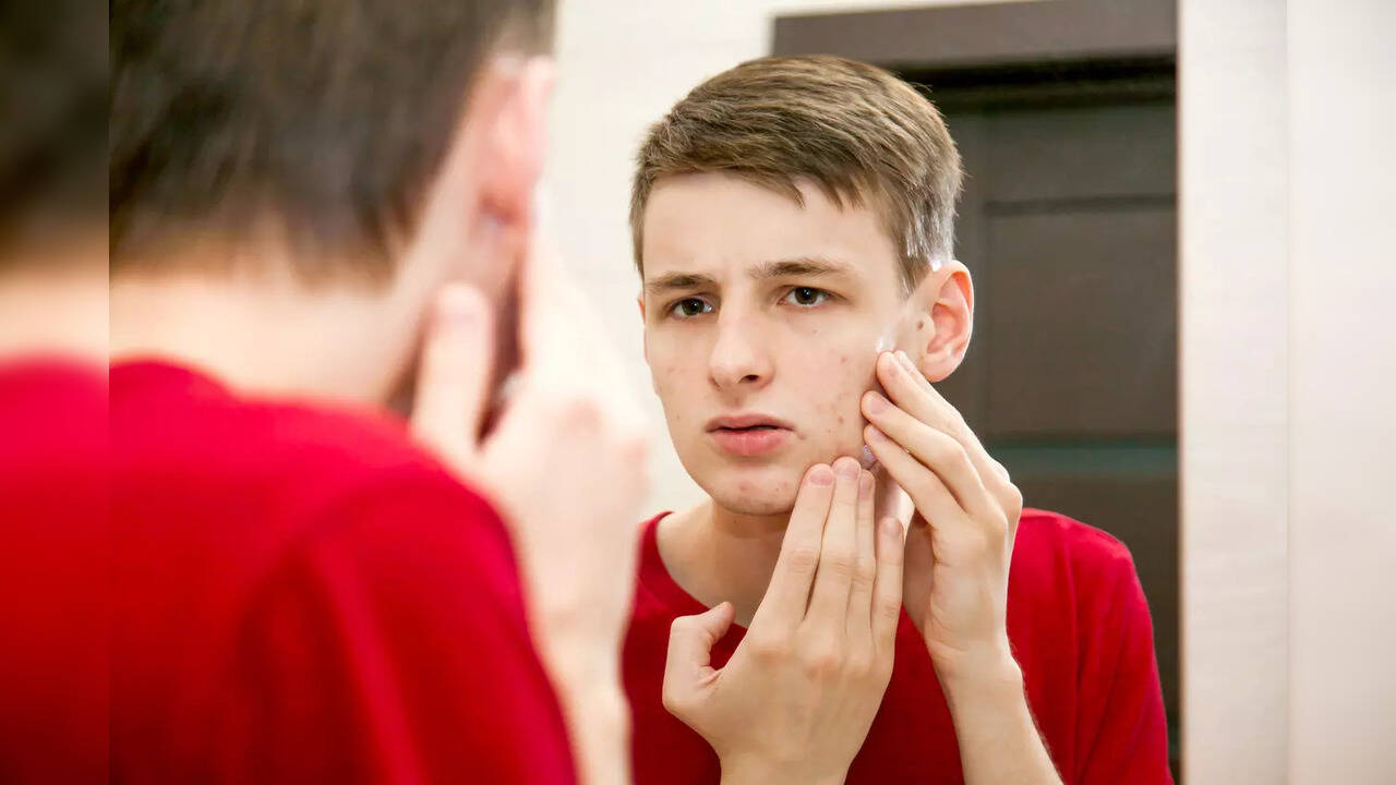 Skincare for men: Tips to consider if you have acne-prone skin | Health ...