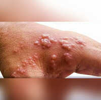 Monkeypox declared disease of national significance by Australia