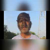 Lalit Patidar werewolf | Madhya Pradesh boy with rare 'werewolf ...