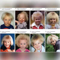 What is Uncombable hair syndrome or Spun glass hair? This Australian ...