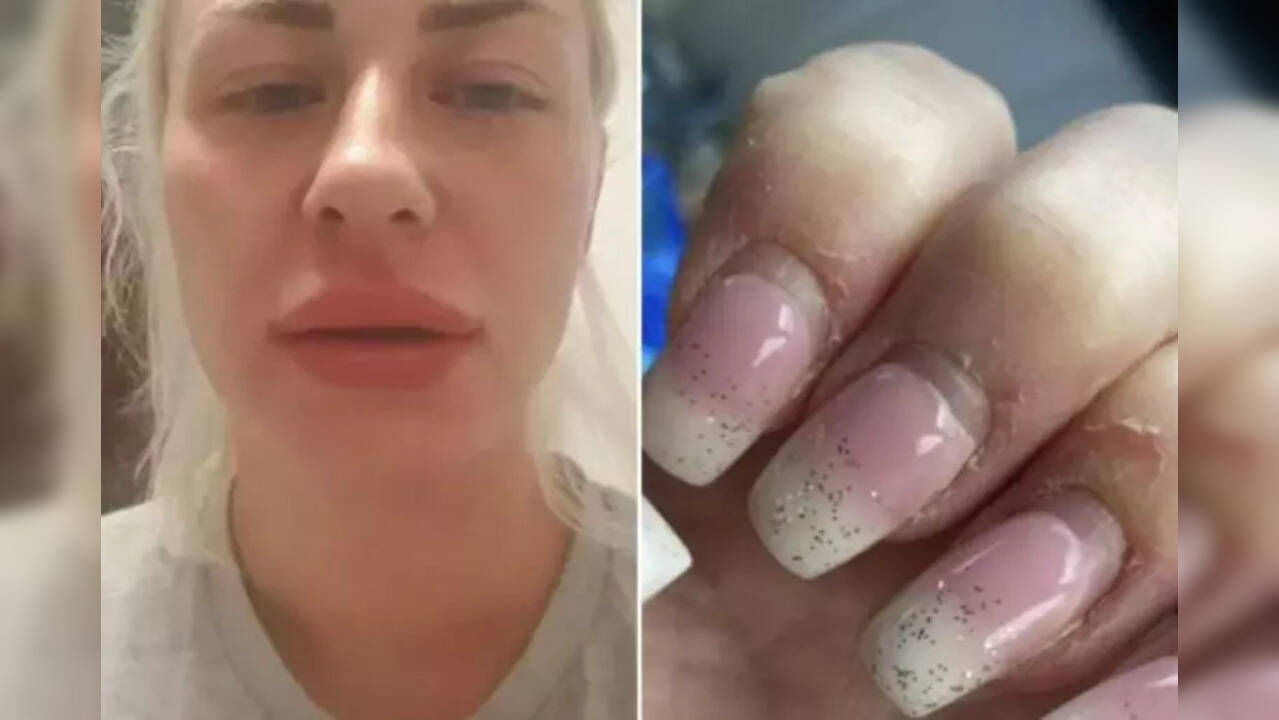 Manicure gone wrong: Woman develops blisters, swelling after a session ...
