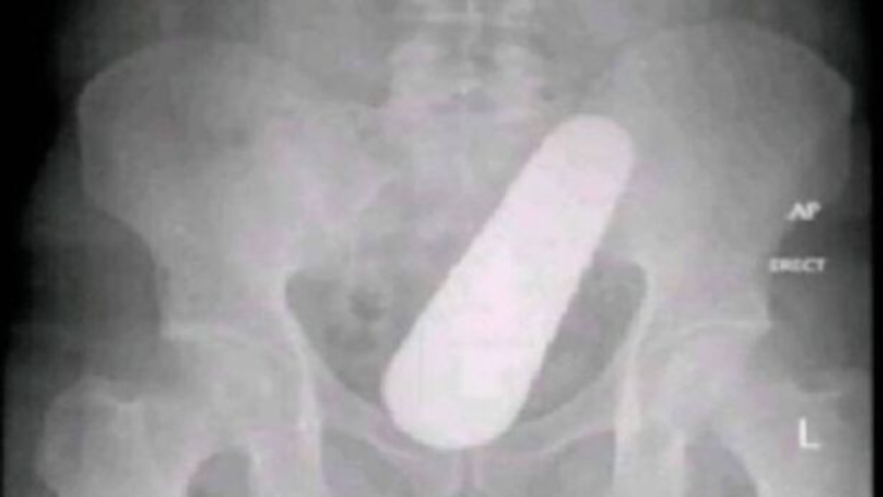 Man With Cucumber Stuck In His Behind Says 'It Grew Inside Me As I Ate ...
