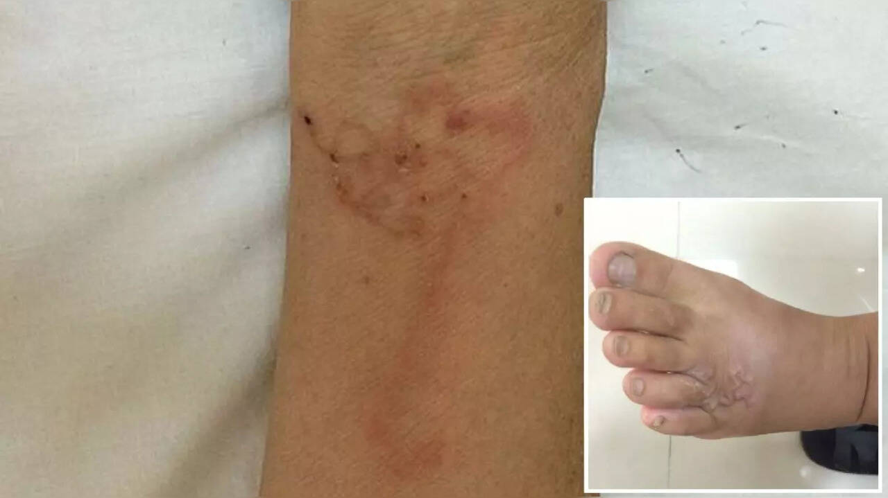 Worms Seen Moving Underneath Woman's Skin After Eating Pudding In ...