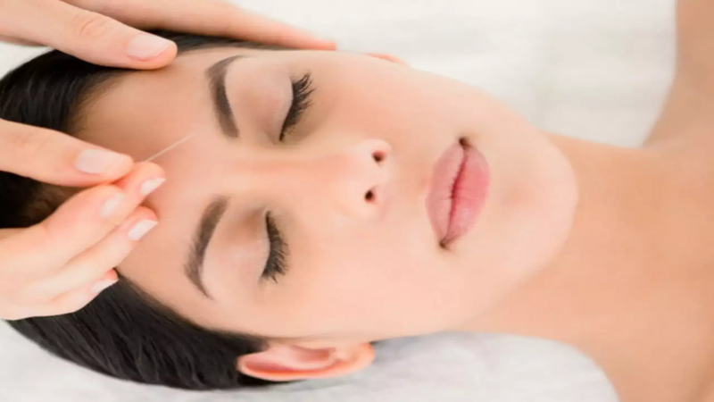 Can facial acupuncture revolutionise your beauty routine? Discover the ...