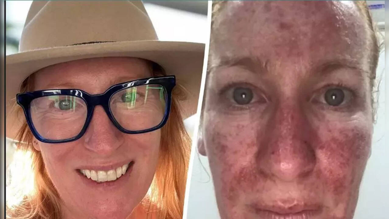 A Woman Has To Continue To Undergo Treatment For A Rare Skin Cancer ...