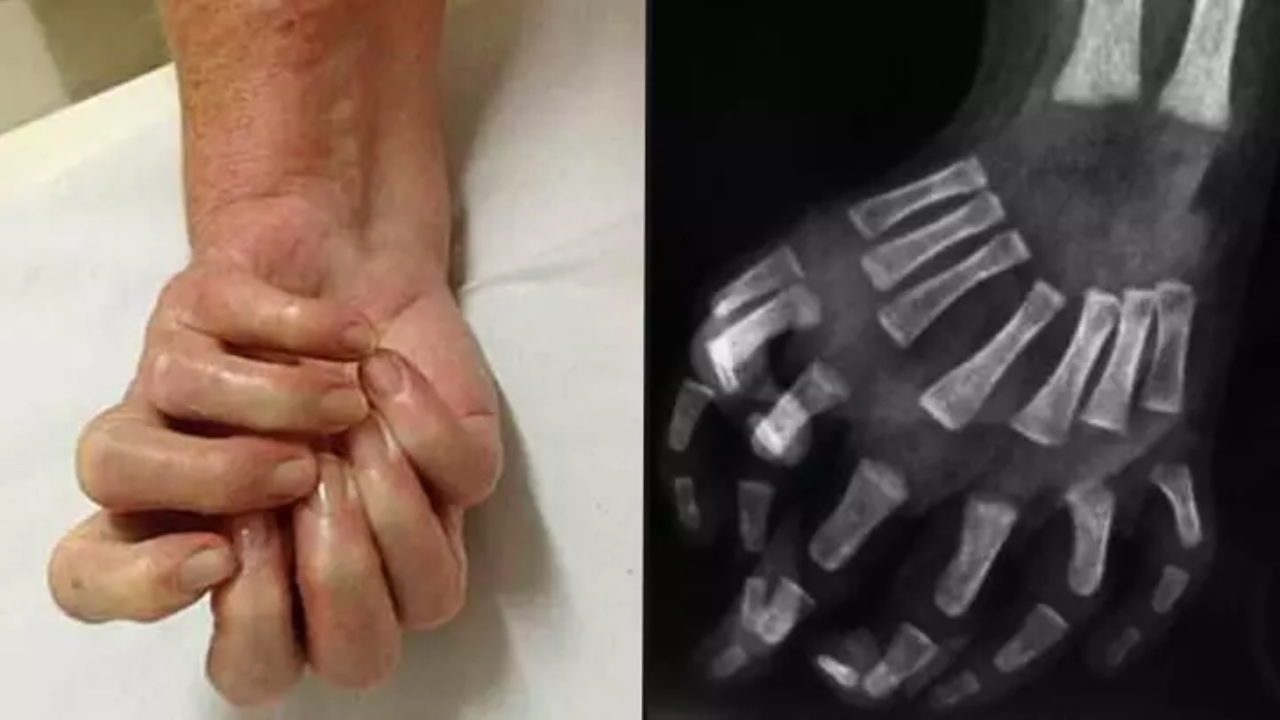 Rare 'mirror hand' syndrome causes people to have a completely ...
