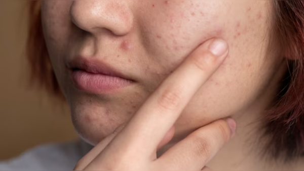 Acne On Face Indicates The Health Of Your Internal Organ; Expert Talks ...