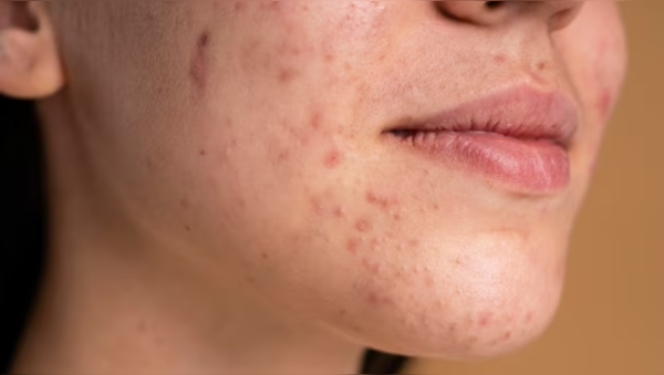 Do You Have Red Spots On Your Skin? Ayurvedic Treatments To Treat Those ...