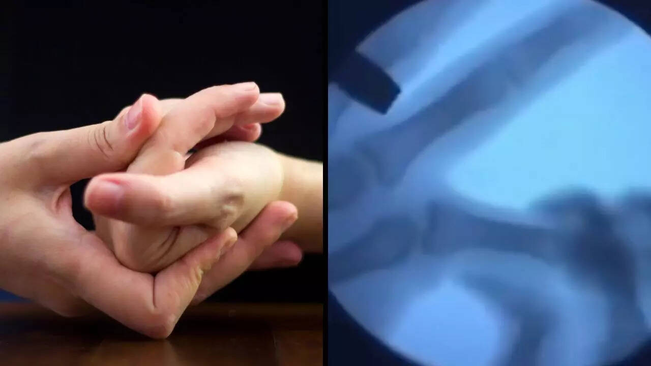No Side Effects: Real-Time X-Ray Video Shows the Impact of Knuckle ...
