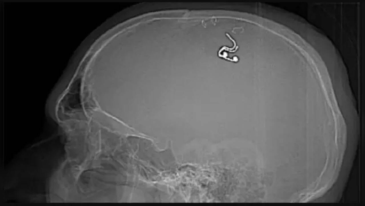 Bizarre! A Russian Man Drills His Skull To Insert Dream Controlling ...