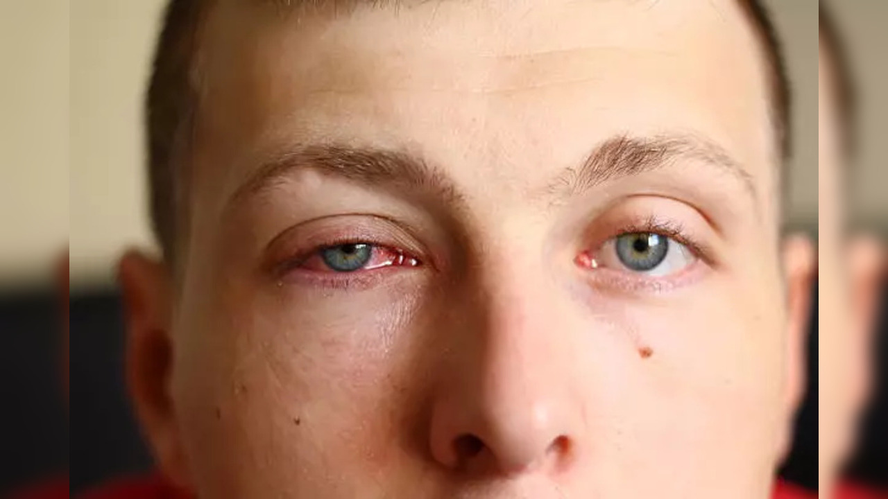 Suffering From Pink Eyes? As cases Of Conjunctivitis Surge Across India ...
