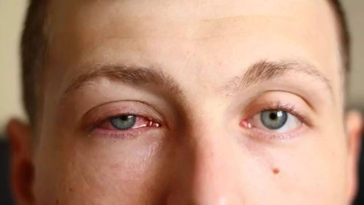 Conjunctivitis Cases on the Rise in Delhi NCR, Average of 100 cases ... Conjunctivitis Cases on the Rise in Delhi NCR, Average of 100 cases ...