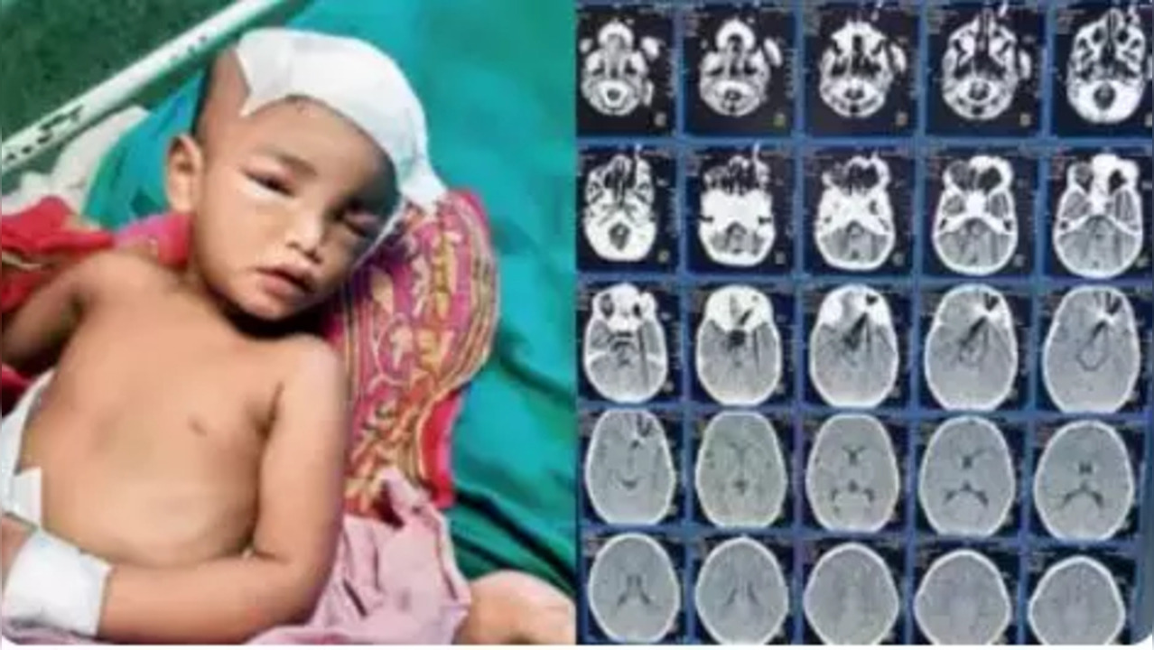 Doctors Save Toddler's Life After Sharp Scissors Pierce Brain | Health ...