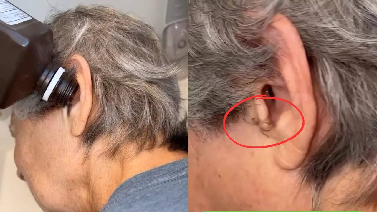 Live Spider Crawls Out Of Woman’s Ear, Viral Video Leaves Netizens ...