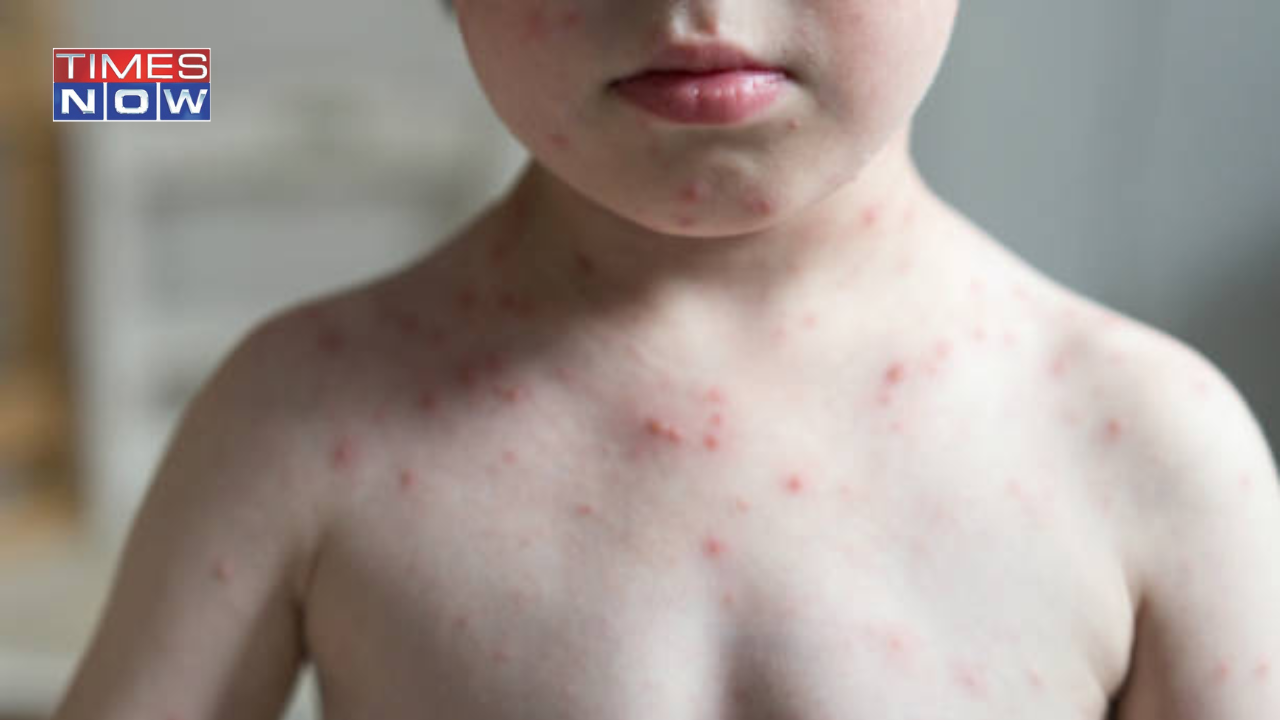New Variant of Chickenpox, Clade 9 Detected in India; Symptoms and ...
