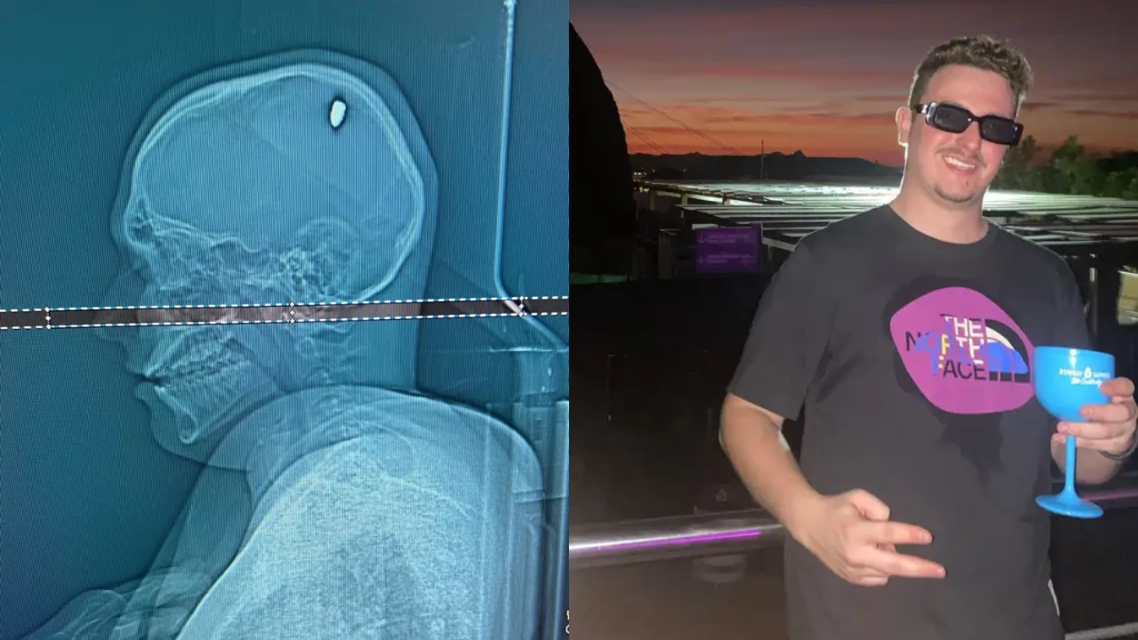 Bizarre! Unaware Of Being Shot In The Head, Man Parties For 4 Days With ...