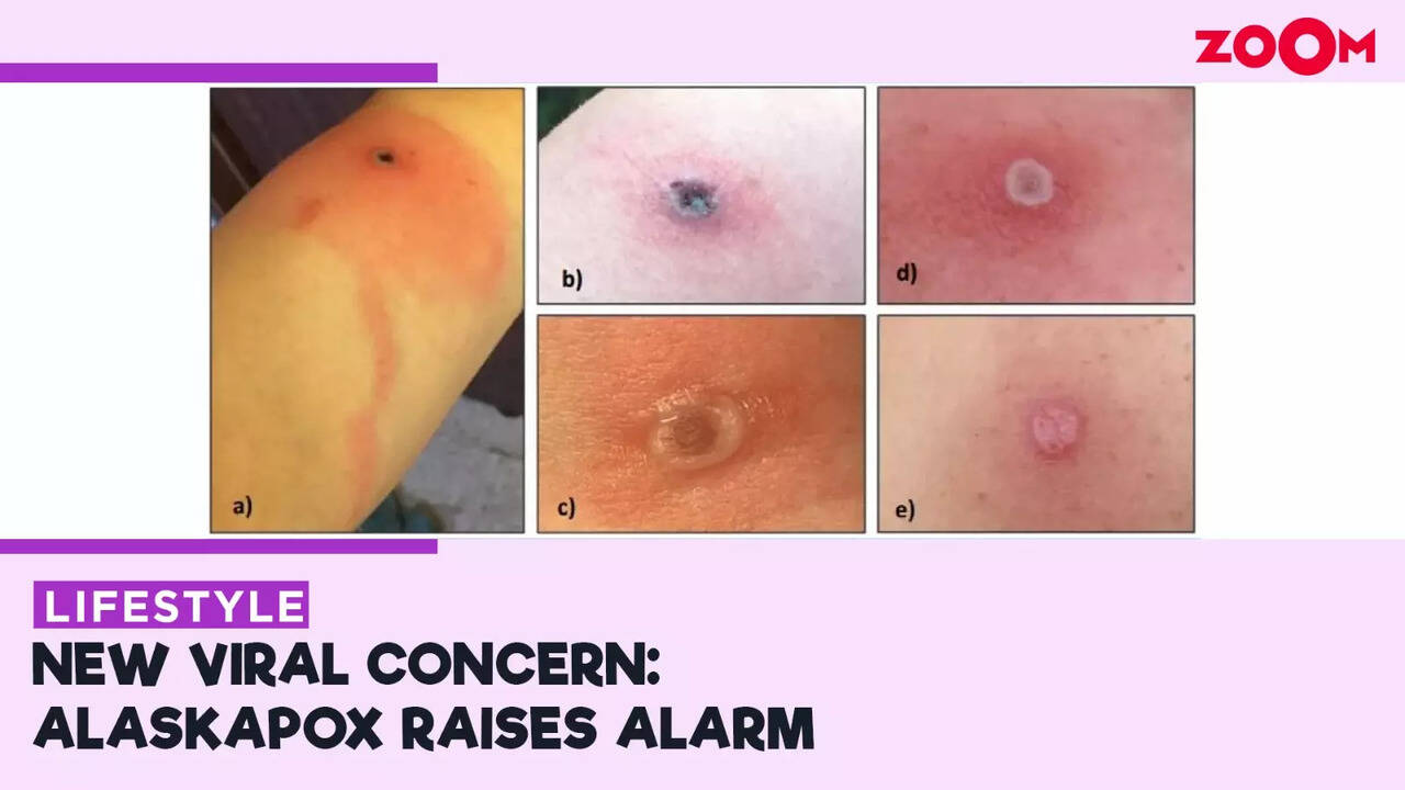 New Viral Concern! Alaskapox raises alarm | Times Now