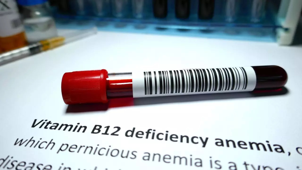 Vitamin B12 Deficiency: Signs Of This Deficiency To Spot On Your Body