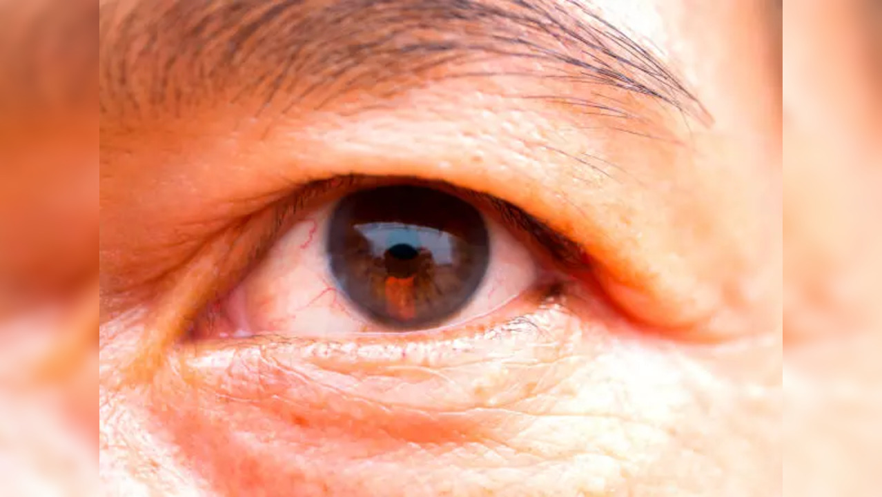 Menacing Signs Of High Cholesterol In Your Eyes That Can Make You Blind ...