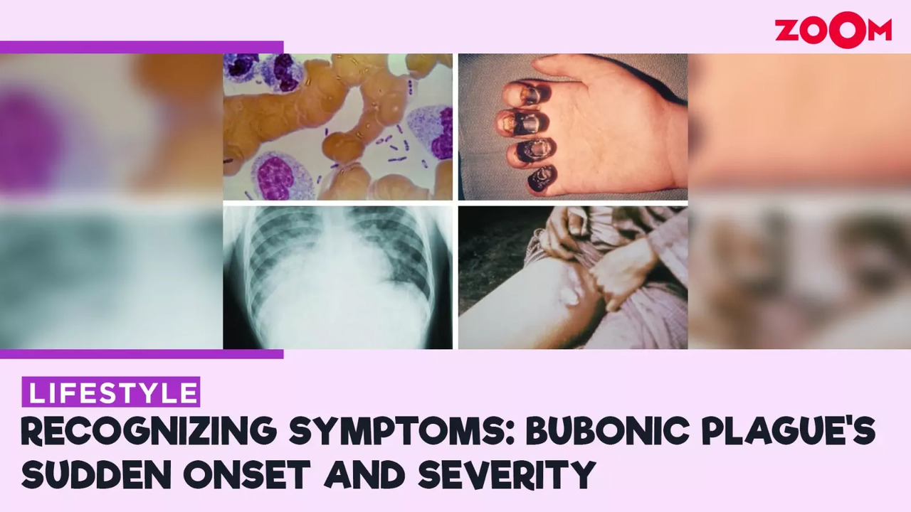 Recognising symptoms: Bubonic Plague's sudden onset and severity | Times Now