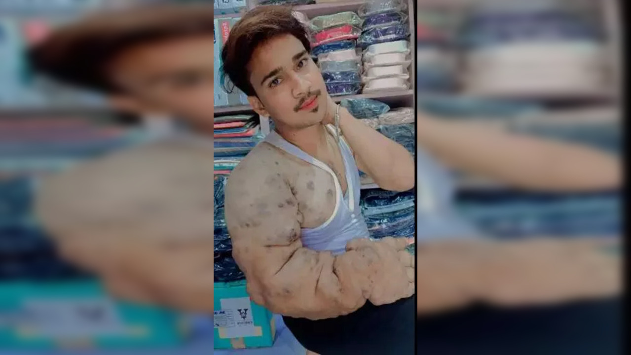 Ghazipur News: Man Born With One Giant Arm Leaves Doctors Puzzled | Health News, Times Now