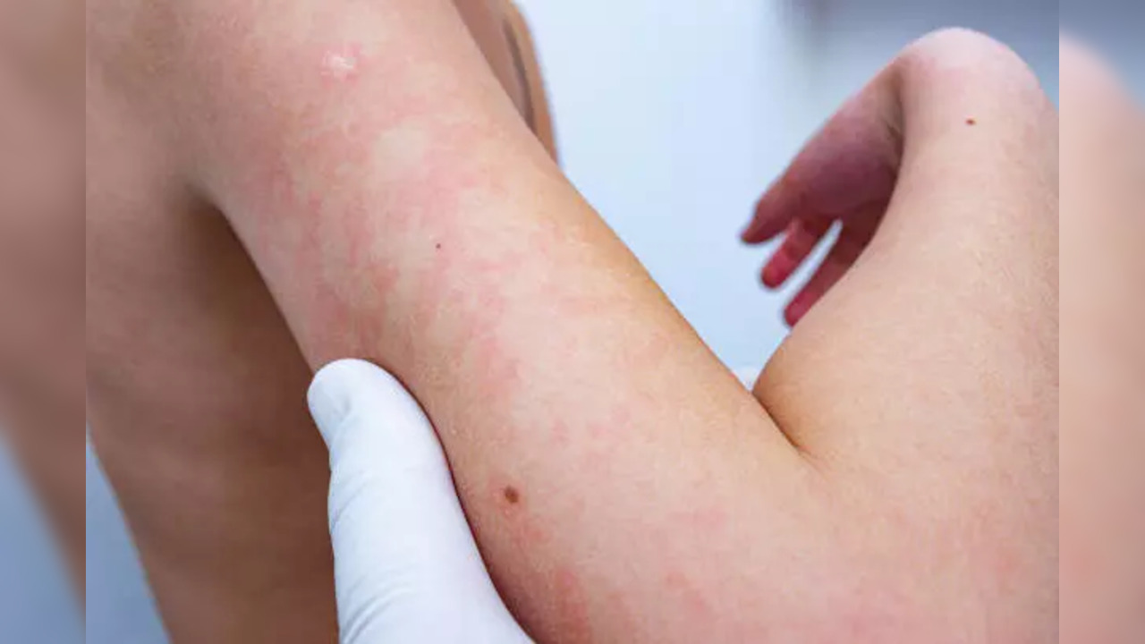 Life-Threatening Skin Rashes and Their Symptoms: From Cancer To ...