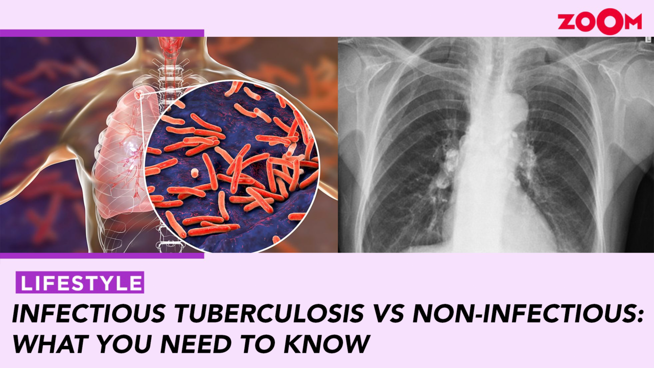 Difference Between Infectious And Non Infectious Tuberculosis | Times Now