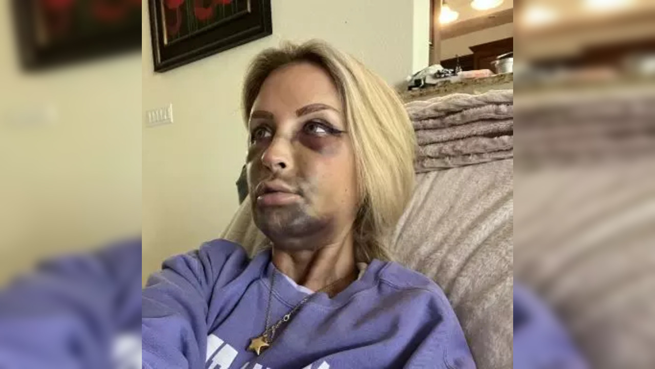 Dental Implants in Woman: Dental Implants Leaves Woman With "Worst ...