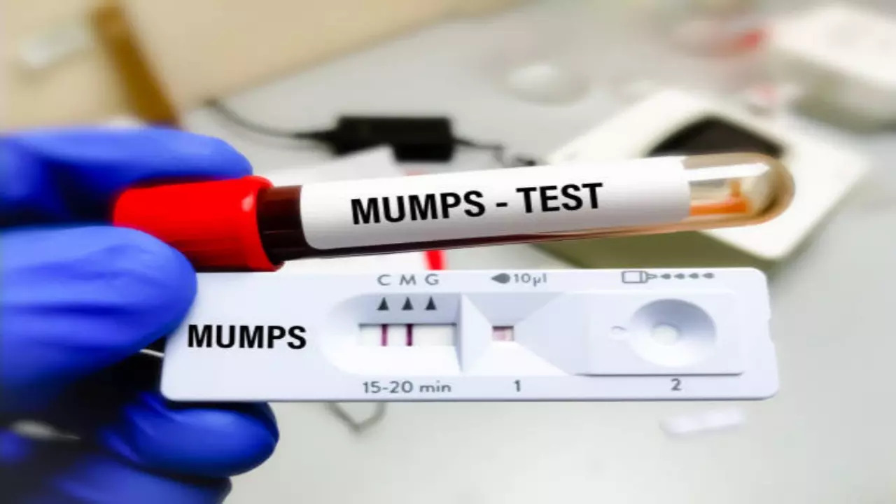 Is There A Mumps Outbreak In Delhi-NCR? What Health Ministry Data Says ...