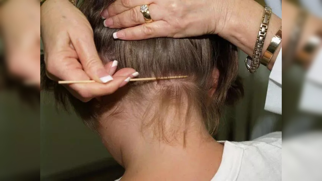 What Are Super Lice? Experts Sound Warning About Their Rise in Canada ...