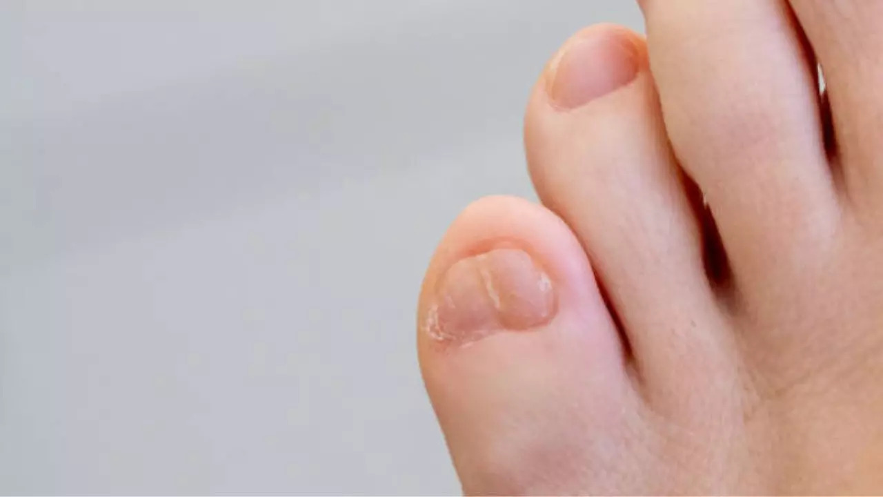 Cancer Symptoms in Nails: Your Nail Colour Can Signal Cancer Risk, Says ...
