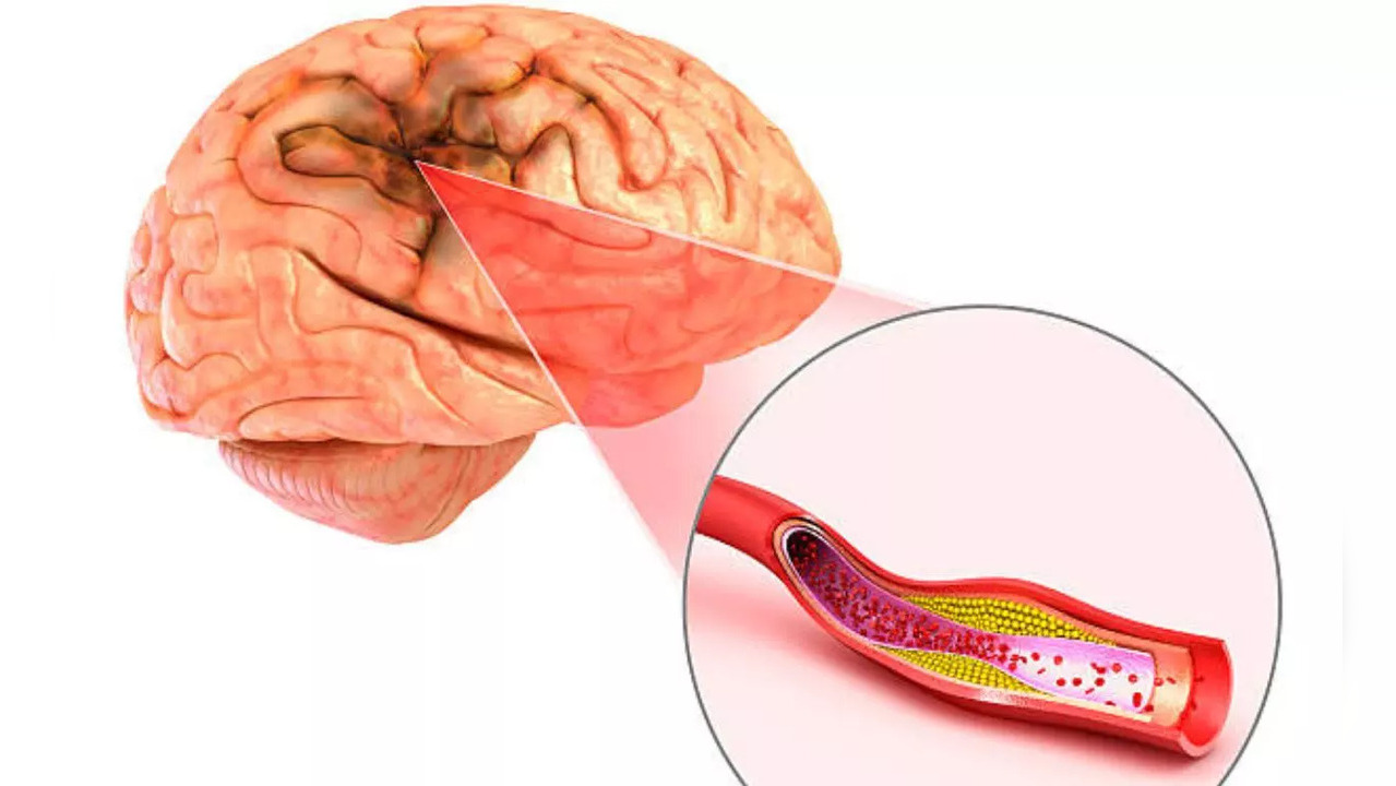 Cerebral Venous Sinus Thrombosis: Severe Dehydration Can Cause Life ...