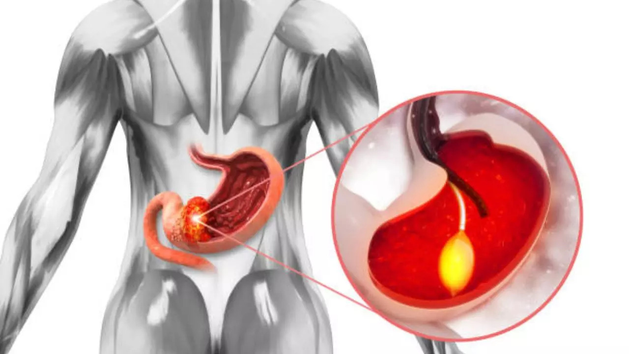 H. pylori Infection: Factors You Must Know To Ease Off Early Symptoms ...