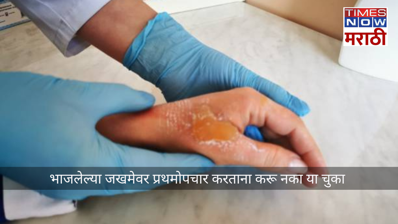 तुम्ही जळालेल्या जागेवर बर्फ किंवा कोलगेट लावता का? अजिबात करू नका ही ...