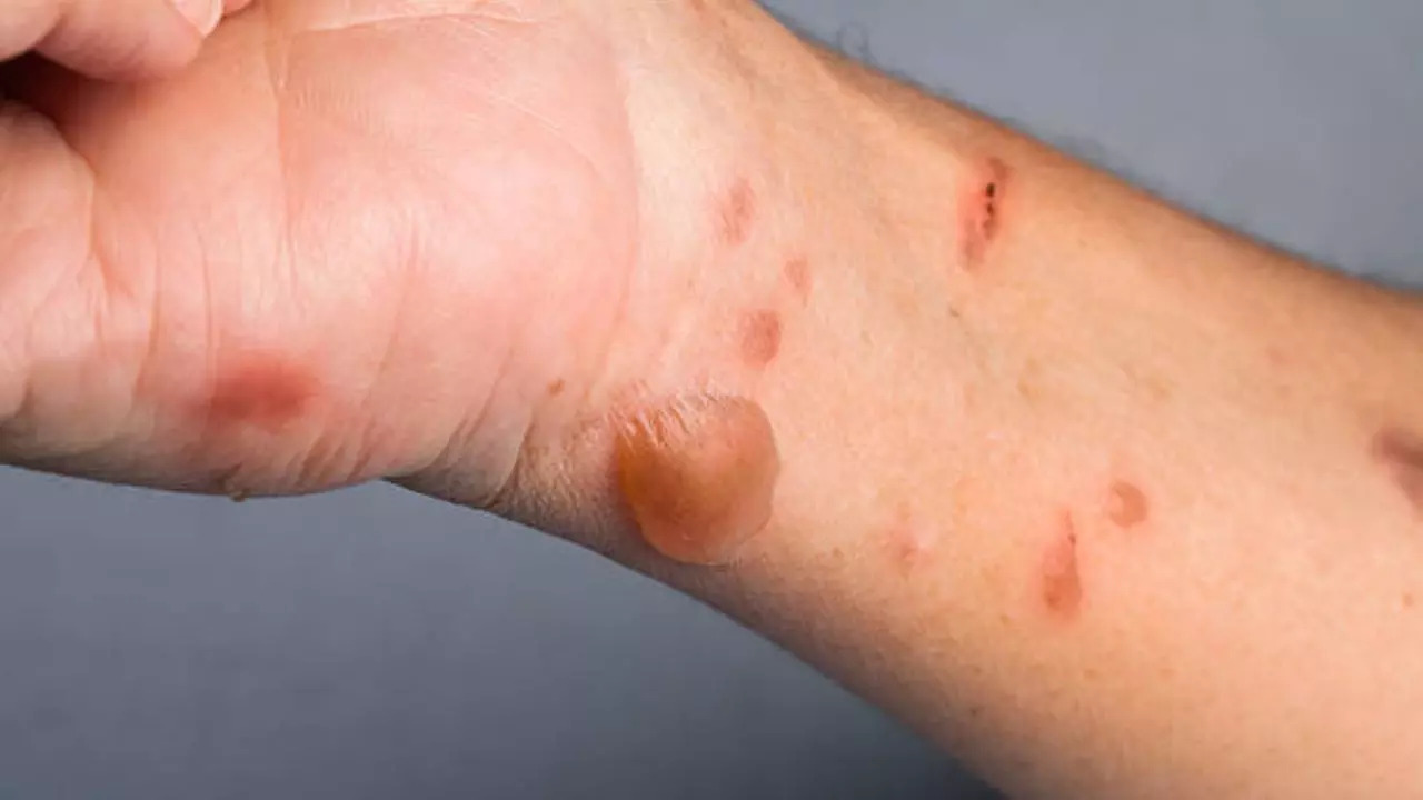 Symptoms of Topical Steroid Withdrawal: Woman Develops Acid Attack-Like ...