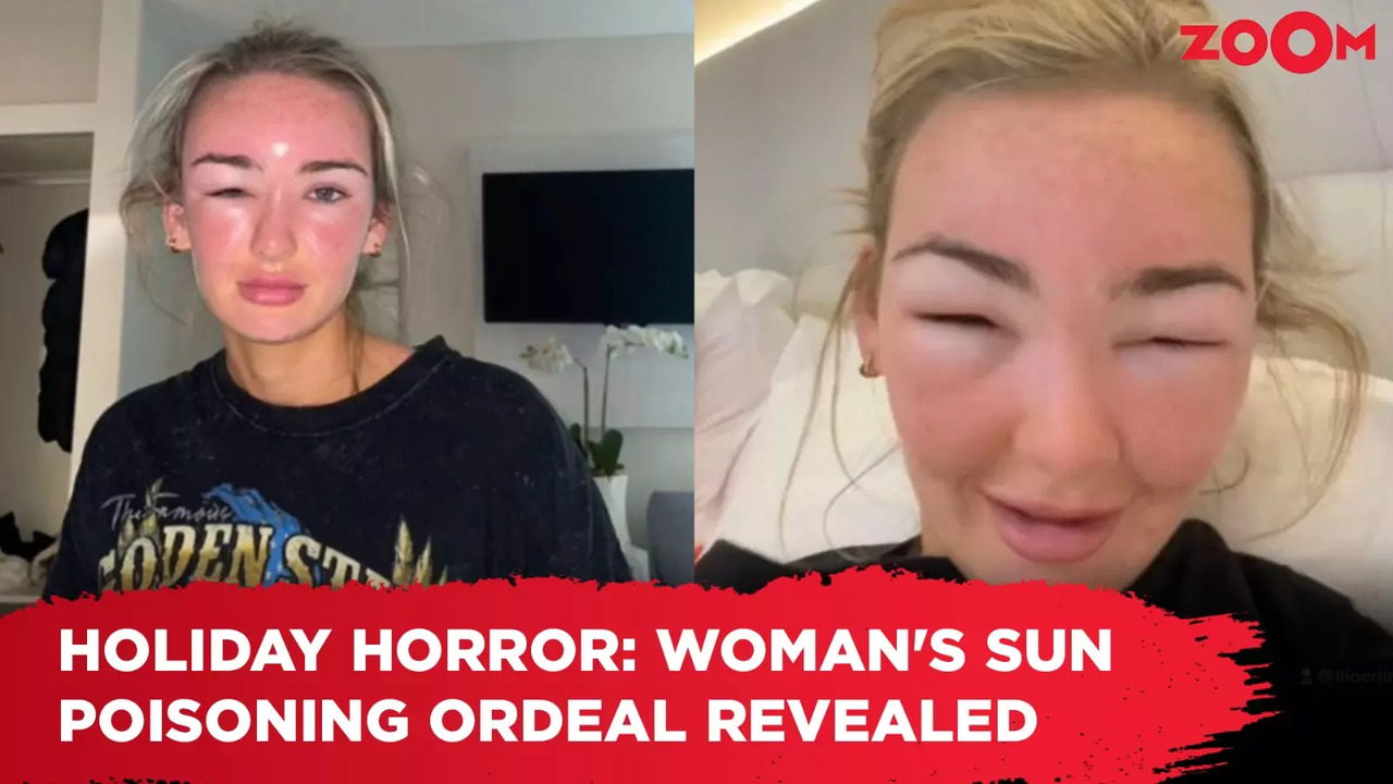 Holiday horror: Woman's 'Sun Poisoning' ordeal revealed | Times Now