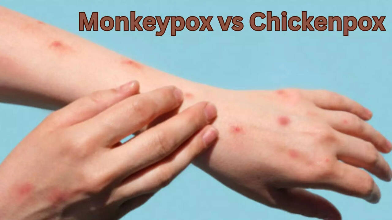 Monkeypox vs Chickenpox: ಮಂಕಿಪಾಕ್ಸ್‌ ಮತ್ತು ಚಿಕನ್‌ಪಾಕ್ಸ್‌ ಮಧ್ಯೆ ಏನು ...