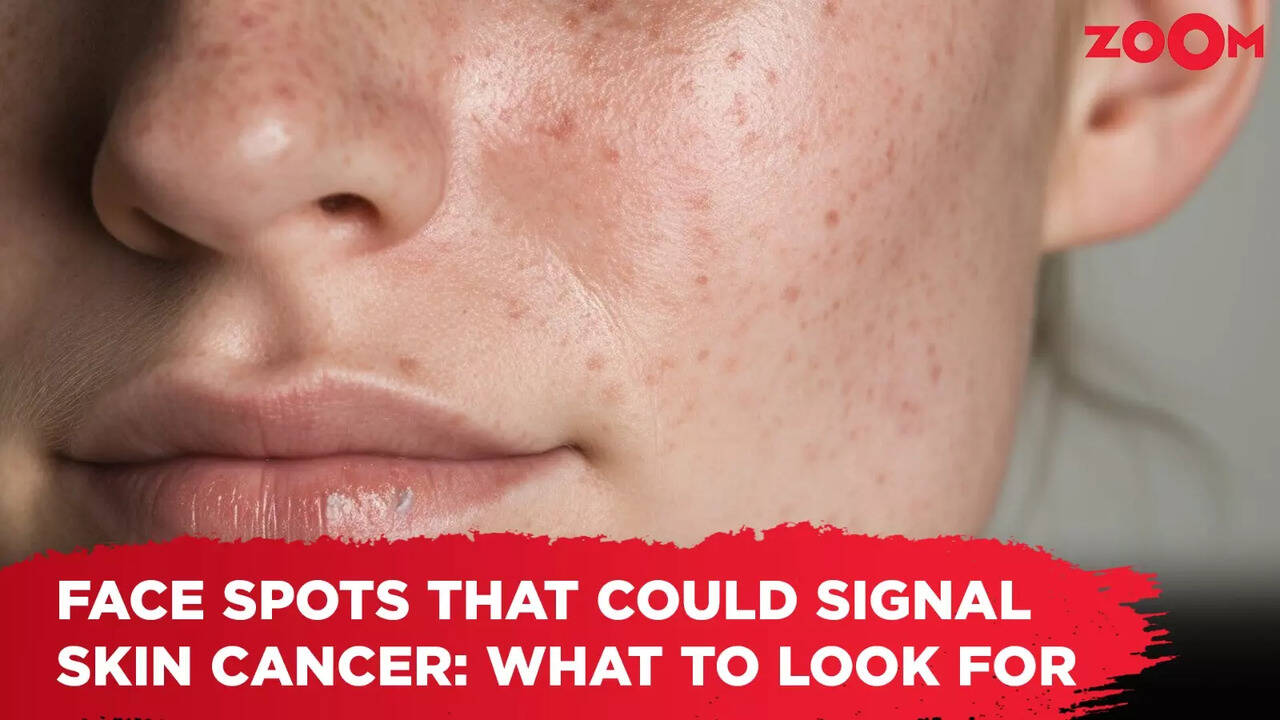 Face spots that could signal skin cancer: What to look for | Times Now