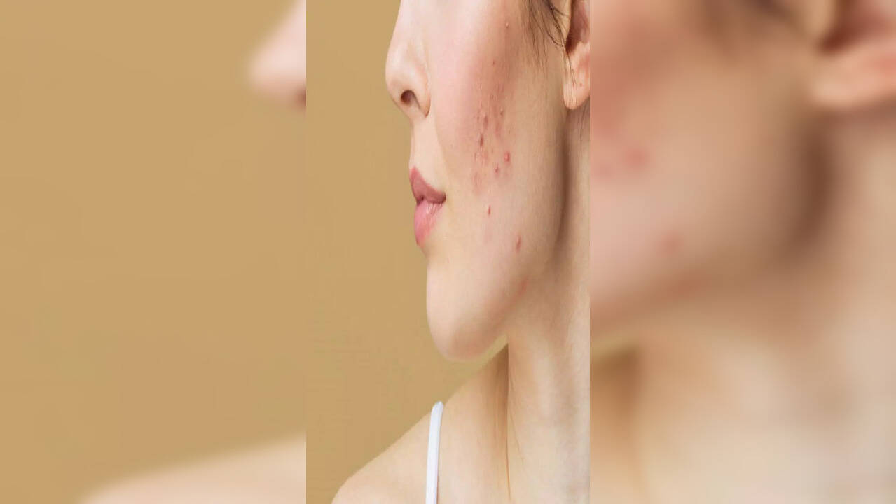 10 Natural ways to prevent acne and pimple on face