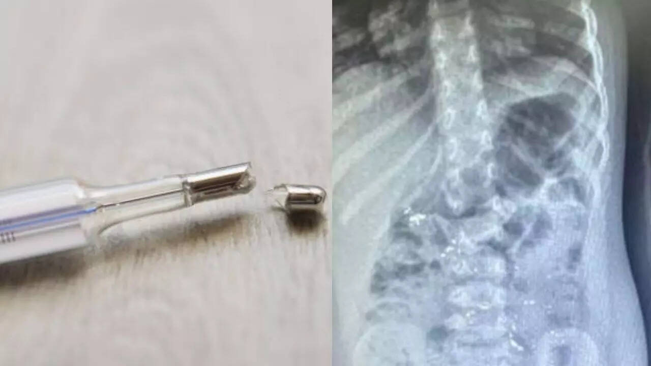 Delhi Doctors Save Toddler From Mercury Poisoning After Thermometer ...