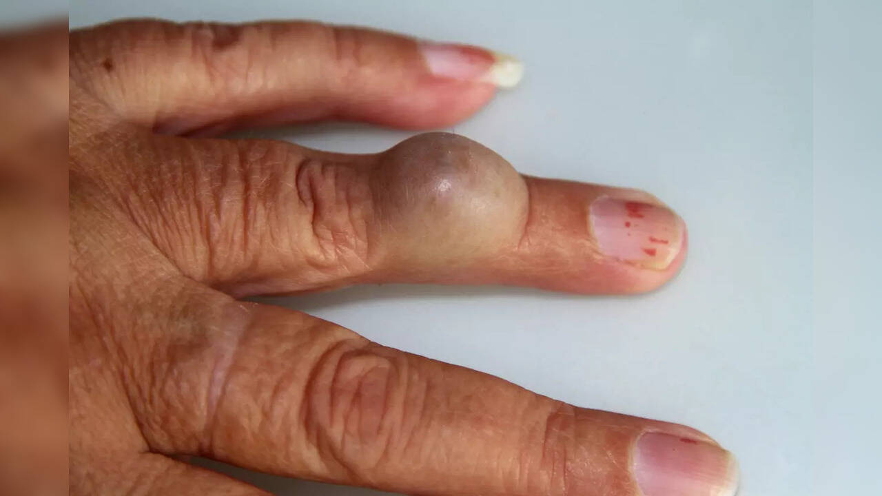 Look at your fingers: Study reveals shocking osteoarthritis symptoms on ...