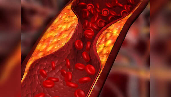 Hypercholesterolemia: Know the signs and management tips | Health News ...