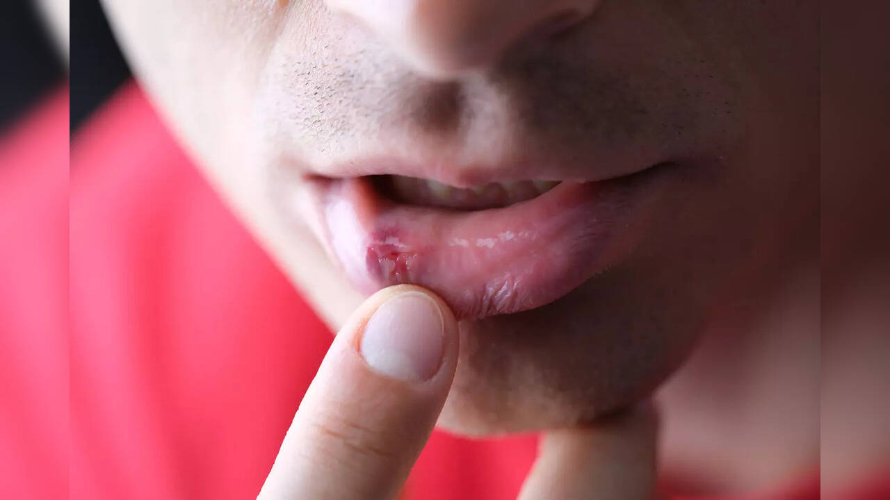 Don't ignore mouth sores: 5 health conditions they could hint at ...